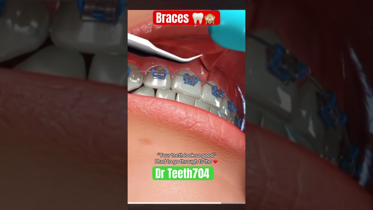 Frenectomy 🦷🙈🙈🙈🙈#_shorts