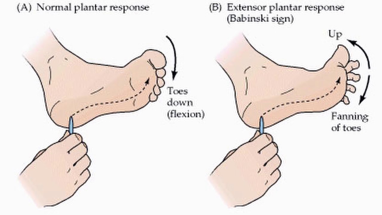 Primitive Reflexes Part 1