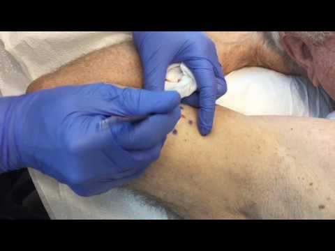 Is this a Sebaceous Cyst? No! It's a lipoma...