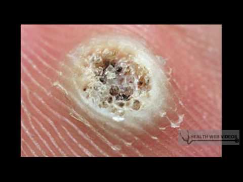 What Causes Genital Warts? Pictures, Symptoms and Remedies