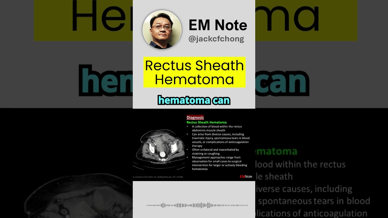 Rectus Sheath Hematoma