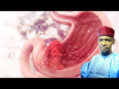 Da wayanan magun-gunan kadai zaka magan ce mummunar Ulcer Da ta addabe ka nan take