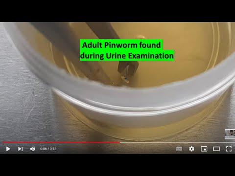 Adult Pinworm found during Urine Examination