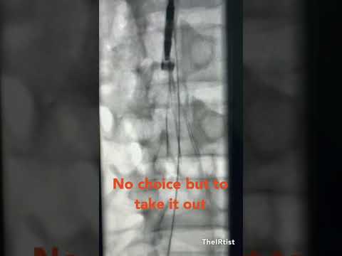 Forceps removal of a problematic IVC filter causing extensive iliocaval thrombosis.