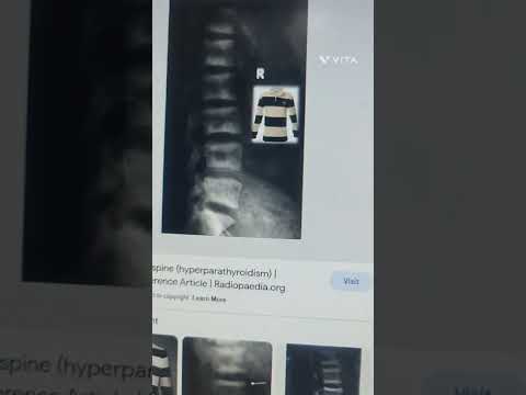 Vertebral body appearances in metabolic bone disorders#orthopedics