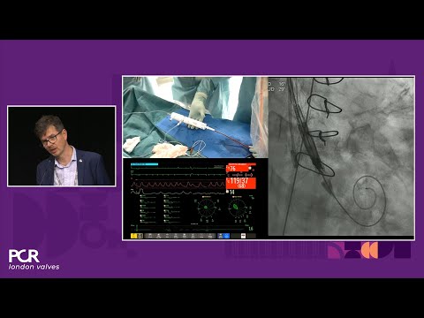Optimisation of valve implantation to ensure lifelong outcomes using a novel self-expanding valve