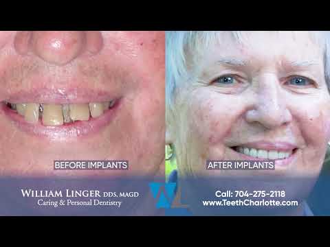 Charlotte Dental Implants Patient Testimonial - Dr. William Linger, DDS