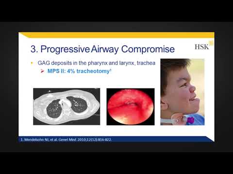 Surgery and otorhinolaryngology: MDT management of Hunter syndrome (MPS II)