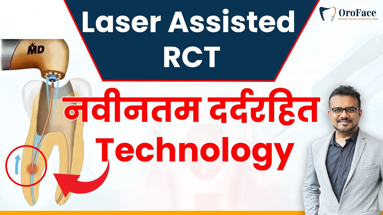 Laser RCT | The Latest Painless Root Canal Treatment Explained