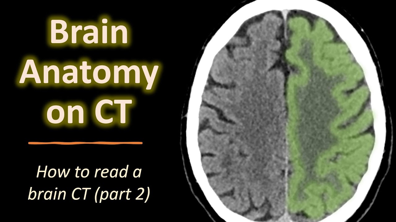 How to read a brain CT (part 2): Brain anatomy on CT