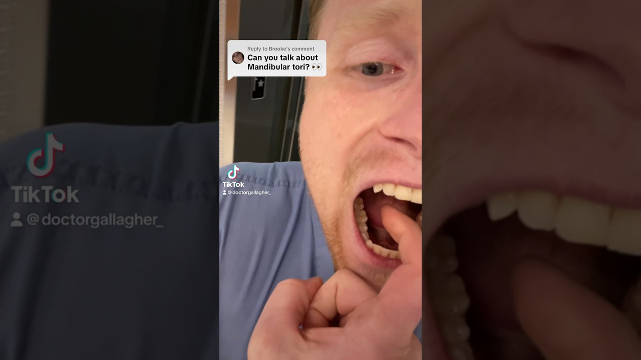 Mandibular Tori 🦴 - Residency Day 903 #oralsurgery #oralsurgeon #doctorgallagher