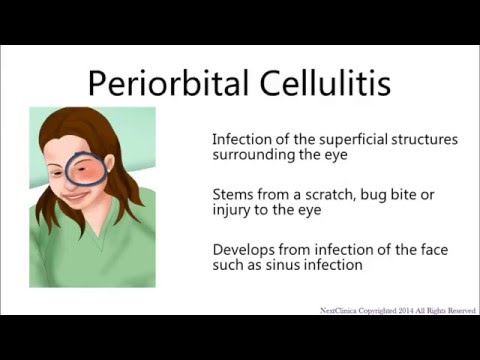 Periorbital cellulitis