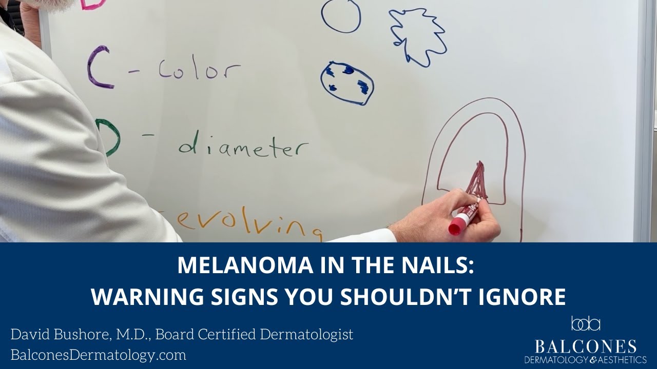 Melanoma in the Nails: Warning Signs You Shouldn’t Ignore