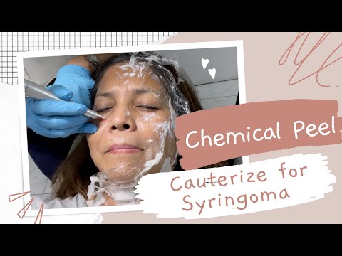 How to Treat Hyperpigmentation and Syringoma?