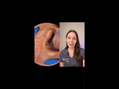 Large blackhead on the ear