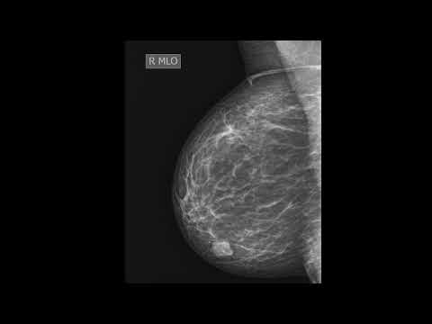 TMT: BREAST IMAGING: Basic Stuff