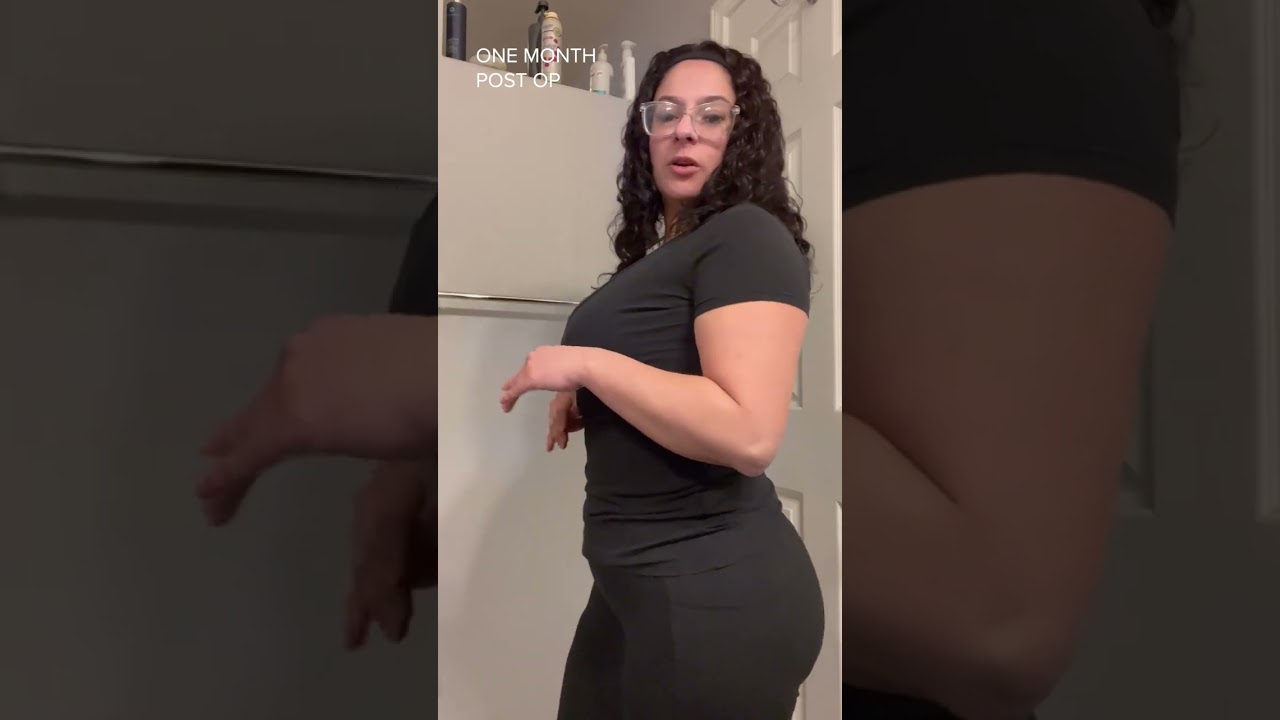 Tummy Tuck Review with Sono Bello | TriSculpt & AbEX Review | Fat Loss Results