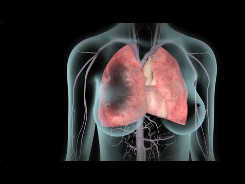 DVT and Pulmonary Embolism | Nucleus Health