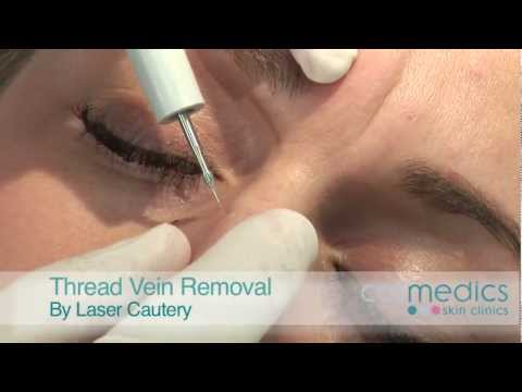 Thread Vein Removal Treatment Face, Legs | Cosmedics Skin Clinics
