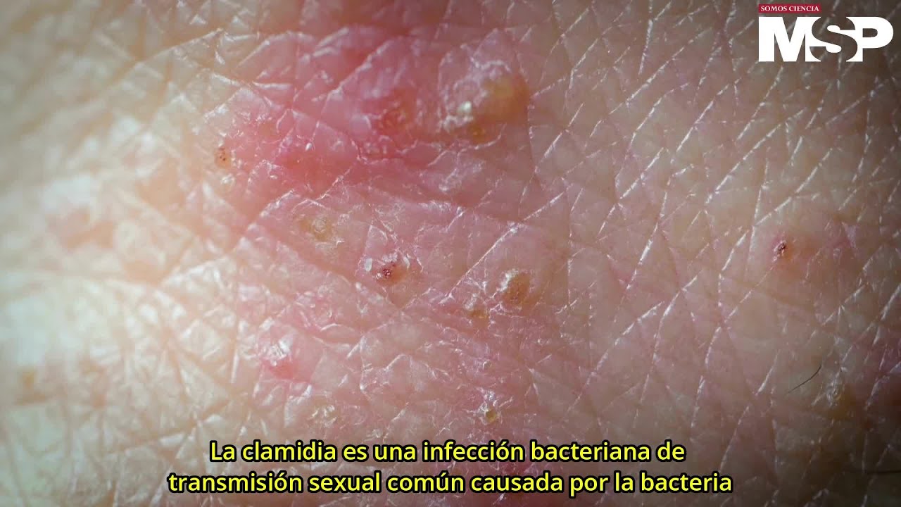 ¿Qué es la clamidia y cómo actúa en el cuerpo? - #ExclusivoMSP