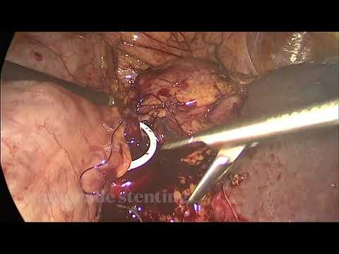 Laparoscopic Pyeloplasty Right done by Anderson Hyne's method