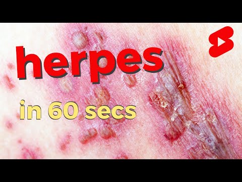 How to know if you have genital herpes #shorts