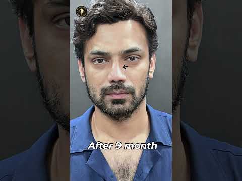 Pakistani famous Actor Zahid Ahmad Nose Story