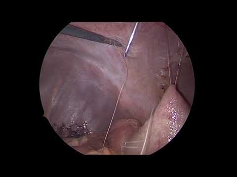 Laparoscopic Feeding Jejunostomy