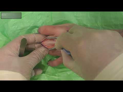 Proximal phalanx Dorsal Approach