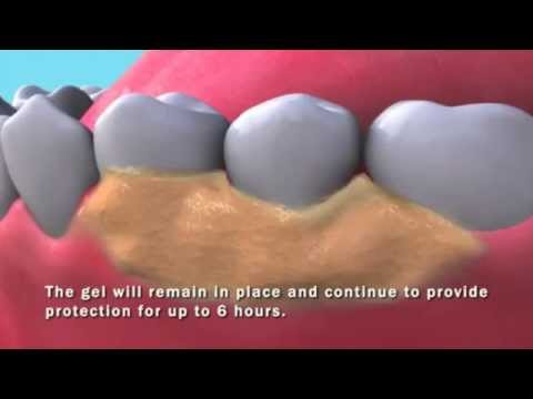 PerioPatch: Topical Patch for Gingival Repair