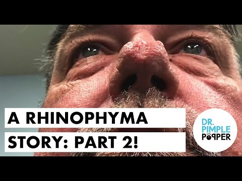 A Rhinophyma Story: Part 2