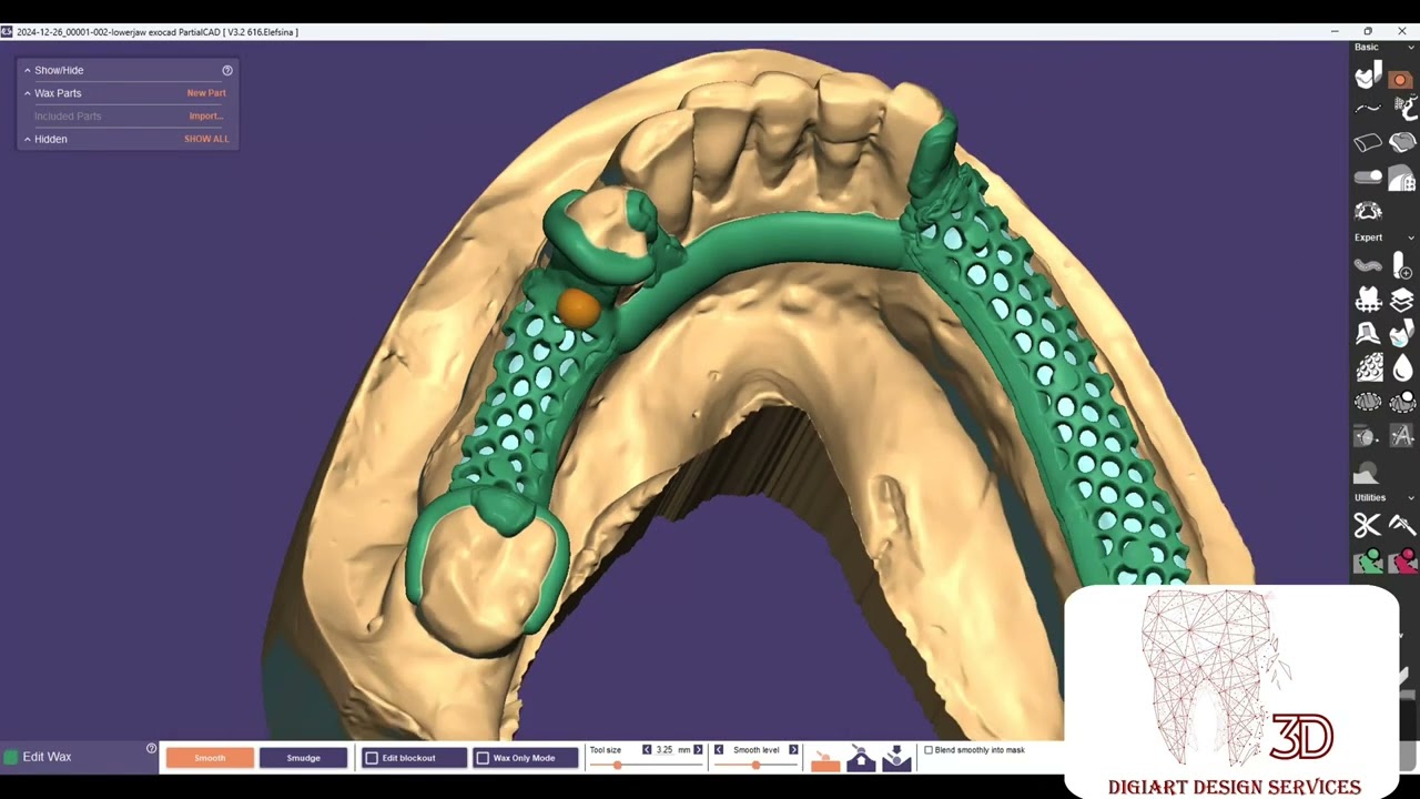 Step by Step Tutorial Designing Removable Partial Dentures with Precision