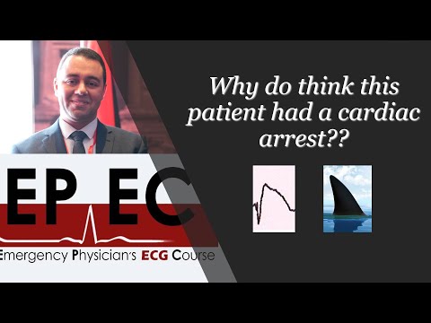 #EPEC ECG Cases (Case 08), Why do think this patient had a cardiac arrest??