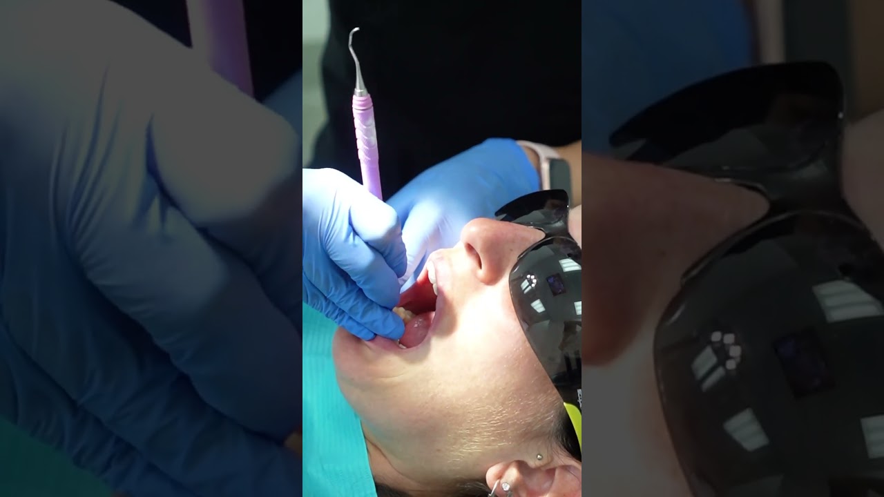 IPR treatment with Bitesoft Pro! #clearaligners #dentist #dentalcare