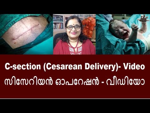 C-Section (Cesarean Delivery)-Video With Narration (മലയാളം)