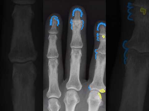 Psoriatic arthritis at a glance