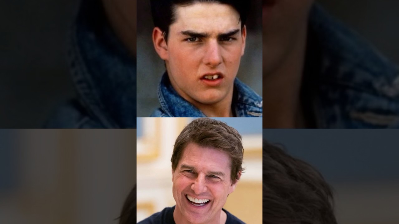 Tom cruise Smile Transformation #smile #tomcruise #dentistry #teeth #dental #drsparshsingh