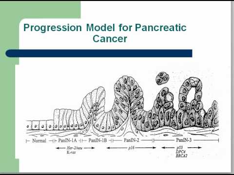 How Do You Get Pancreatic Cancer?