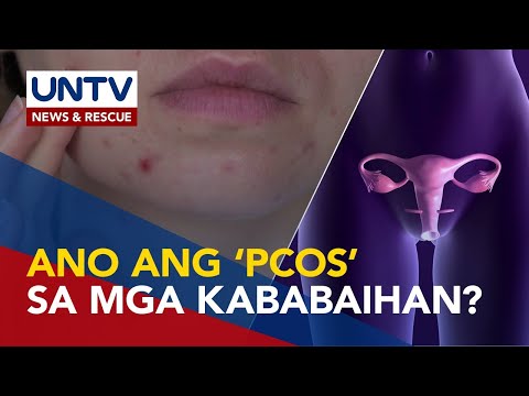 Polycystic ovarian syndrome, isang metabolic disease