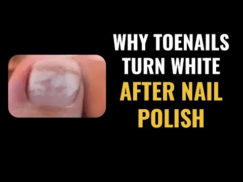 WHITE Toenails after Nail Polish - QUICK TREATMENT FROM PODIATRIST