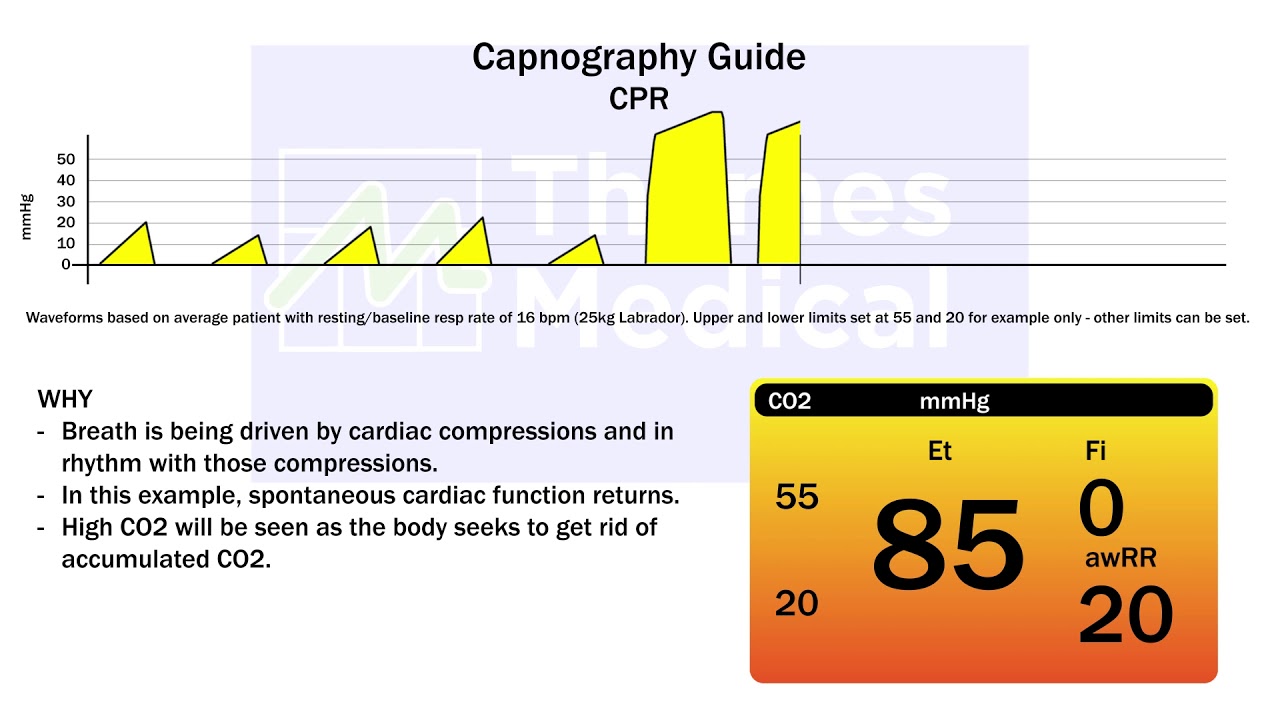 Capnography Waveforms: CPR