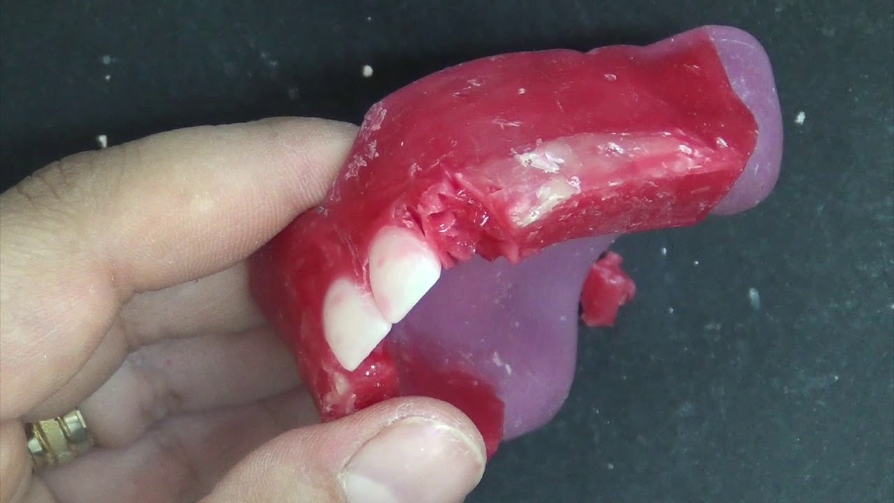 Maxillary Anterior Teeth Setting