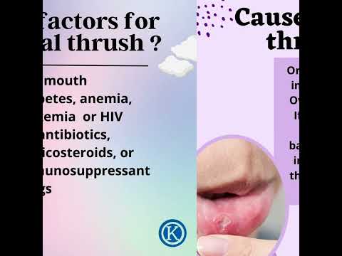Oral Thrush#oralthrush#drkukrejakalani#kenthomeopathyclinic#8291492566#hiranandanipowai#mumbai#kent