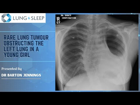 Rare lung tumour obstructing the left lung in a young girl