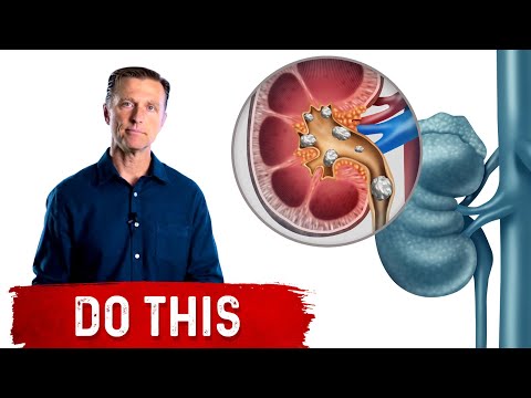 1st Sign of a Kidney Stone: Do This – Kidney Stone Remedies – Dr.Berg