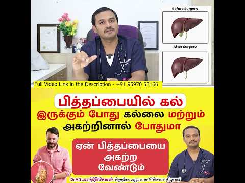 பித்தப்பையில் கல் இருக்கும் போது கல்லை மற்றும் அகற்றினால் போதுமா ஏன் பித்தப்பையை அகற்ற வேண்டும்
