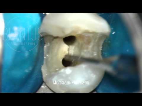 Microsonic in Endodontics