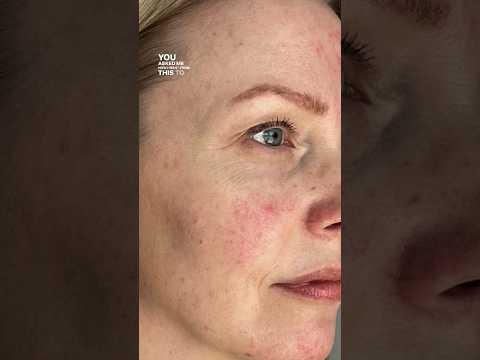 ROSACEA skin care TREATMENT ‼