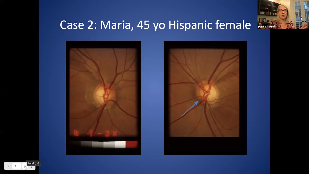 Maximizing the OCT in Glaucoma