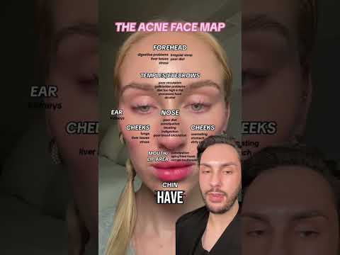 Acne Facial Skin Mapping | What Does Your Pimples Mean? | MaximumSkin
